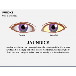 Free Jaundice PowerPoint and Google Slides Template - PPT Slides