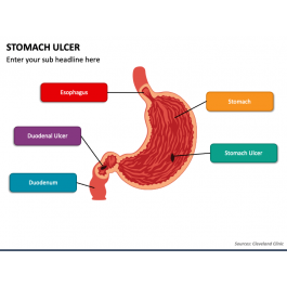Surgical Management Of Peptic Ulcer Disease Ppt Presentation ...