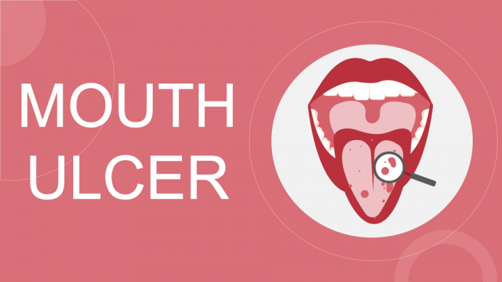 Mouth Ulcer PowerPoint and Google Slides Template - PPT Slides