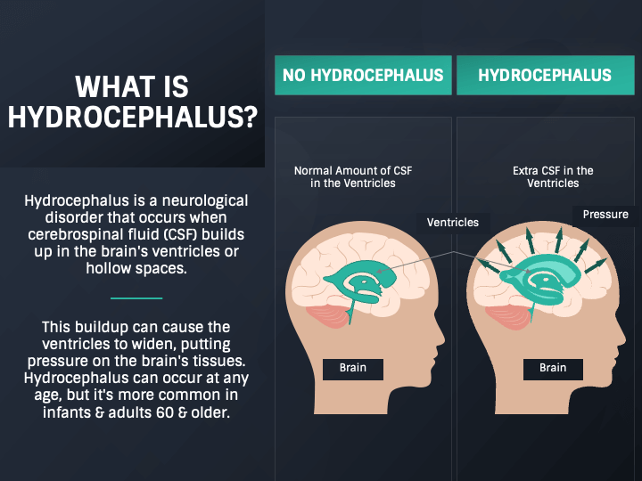 Free Hydrocephalus PowerPoint and Google Slides Template - PPT Slides