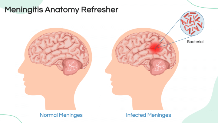 Meningitis PowerPoint and Google Slides Template - PPT Slides
