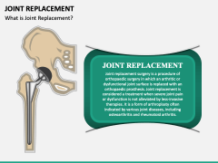 Joint Replacement PowerPoint and Google Slides Template - PPT Slides