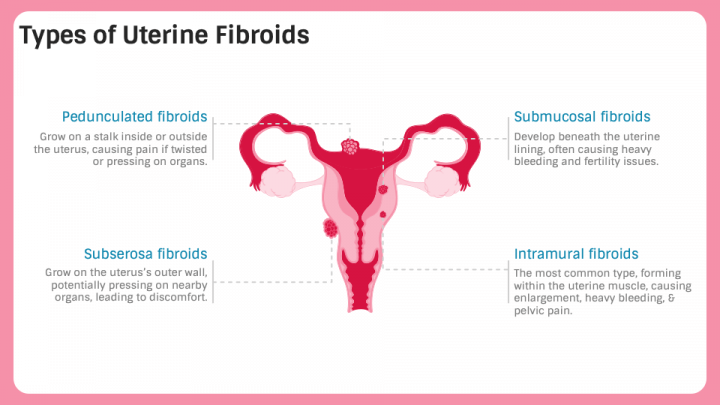 Uterine Fibroid PowerPoint and Google Slides Template - PPT Slides