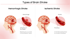Brain Stroke PowerPoint and Google Slides Template - PPT Slides