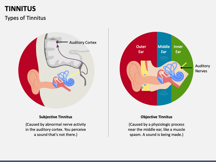 Tinnitus PowerPoint and Google Slides Template - PPT Slides
