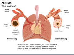 Free Asthma PowerPoint and Google Slides Template - PPT Slides