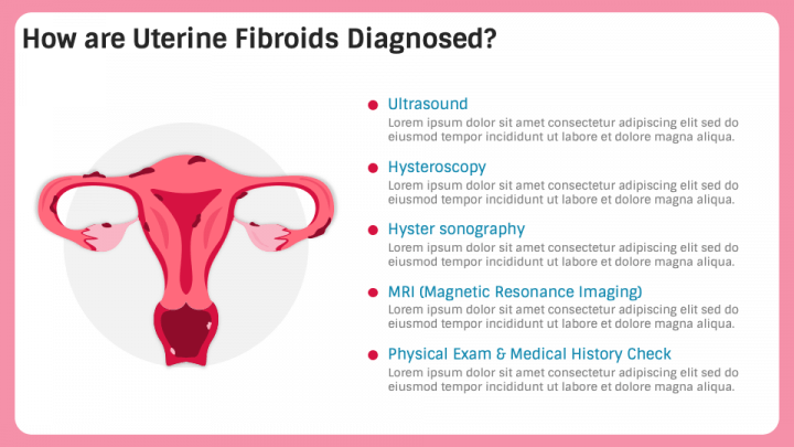 Uterine Fibroid PowerPoint and Google Slides Template - PPT Slides