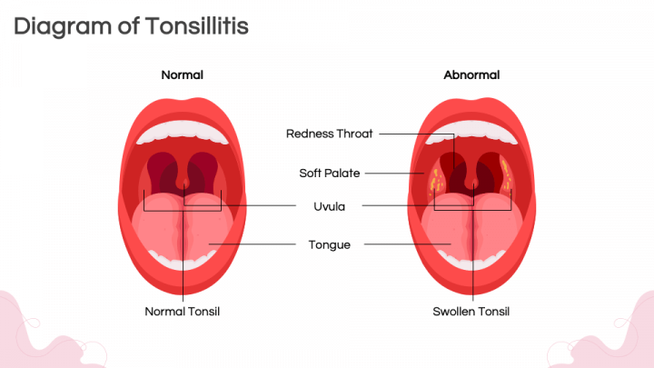 Tonsillitis PowerPoint and Google Slides Template - PPT Slides