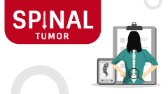 Spinal Tumor PowerPoint and Google Slides Template - PPT Slides