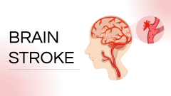 Free - Brain Stroke PowerPoint and Google Slides Template - PPT Slides