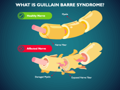 Free Guillain-Barre Syndrome (GBS) PowerPoint and Google Slides Template - PPT Slides