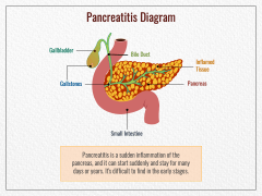 Pancreatitis PowerPoint and Google Slides Template - PPT Slides