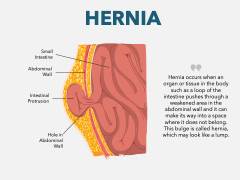 Hernia PowerPoint and Google Slides Template - PPT Slides
