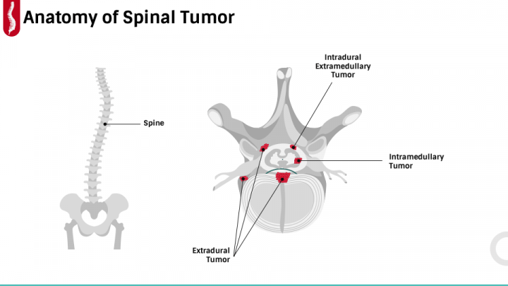 Spinal Tumor PowerPoint and Google Slides Template - PPT Slides