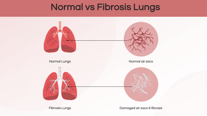 Pulmonary Fibrosis PowerPoint and Google Slides Template - PPT Slides